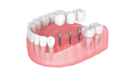 Replacing Multiple Missing Teeth | Implant-Retained Bridges